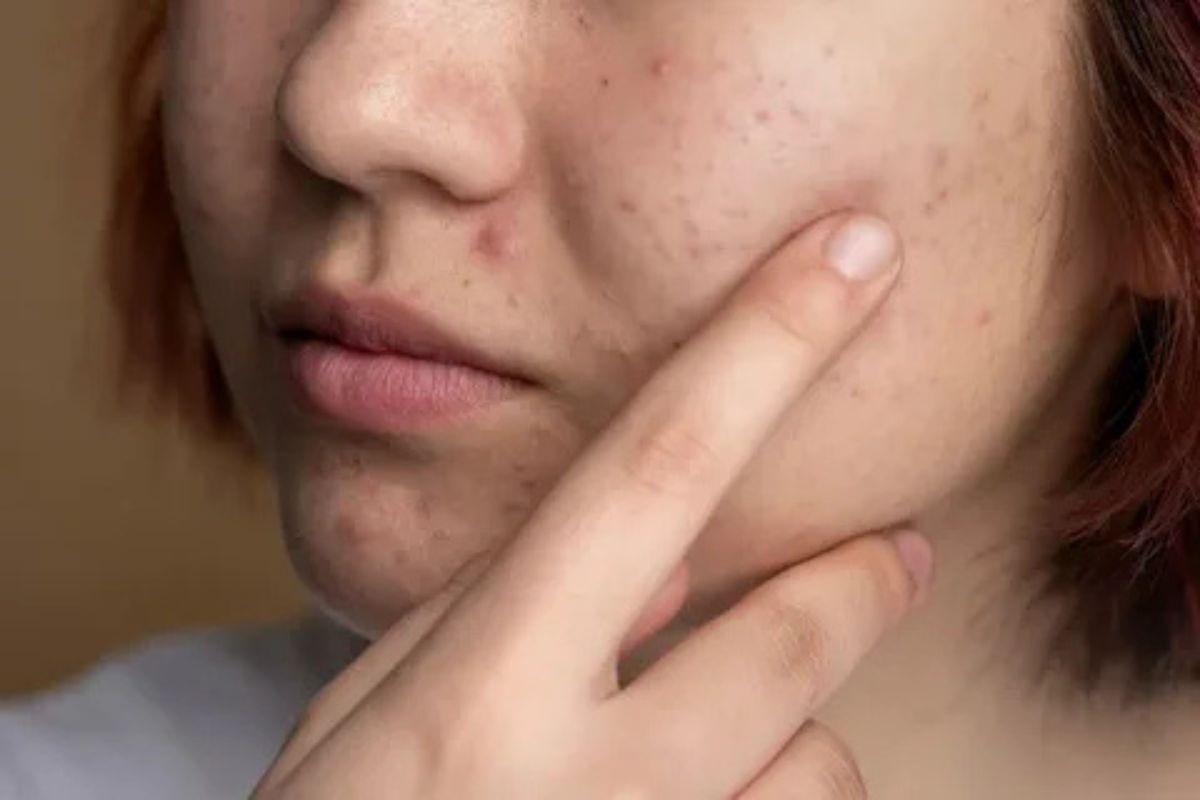 How to Reduce Red Spots on Face Quickly and Safely - House Of Skin